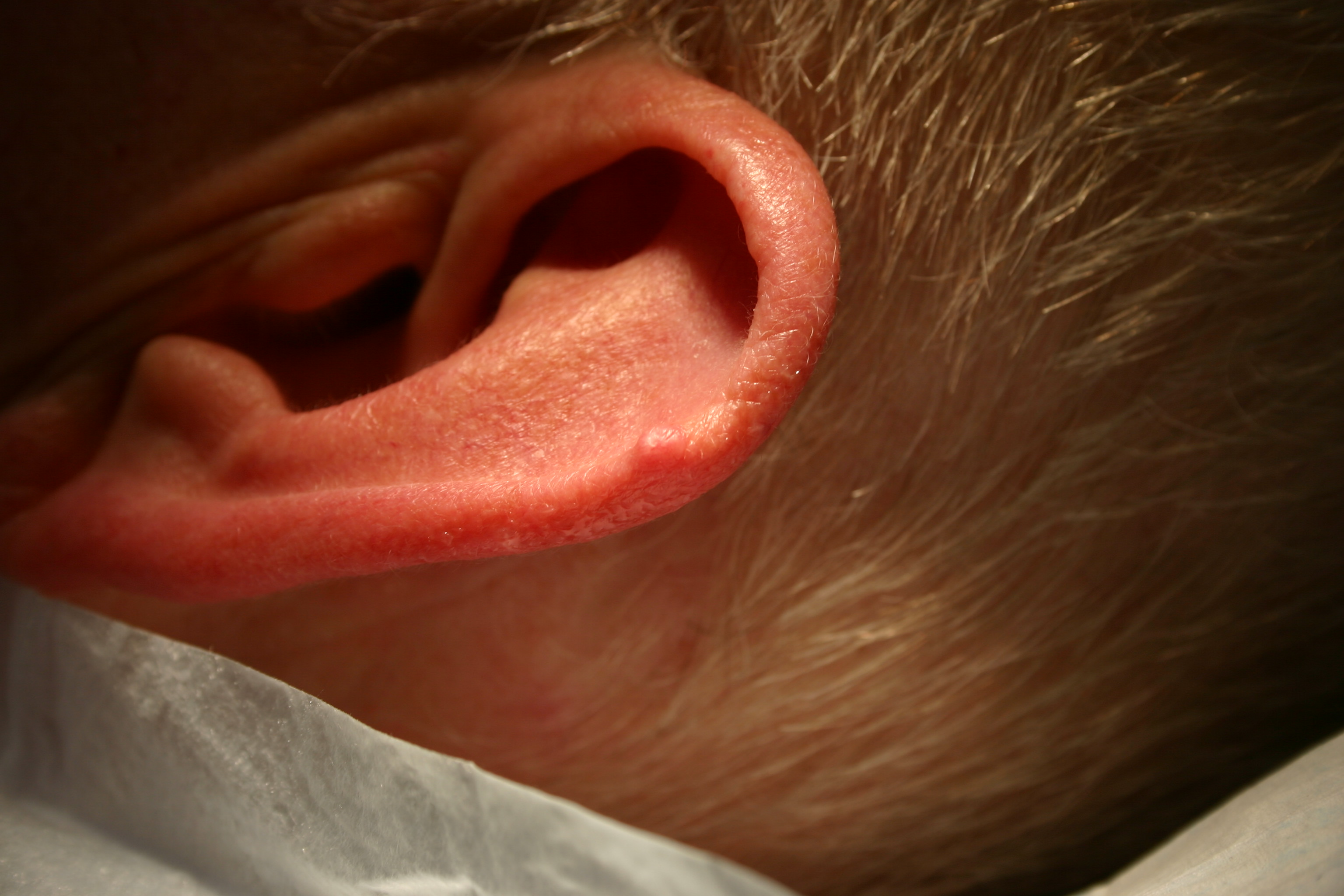 Chondrodermatitis Nodularis Helicis (CNH)