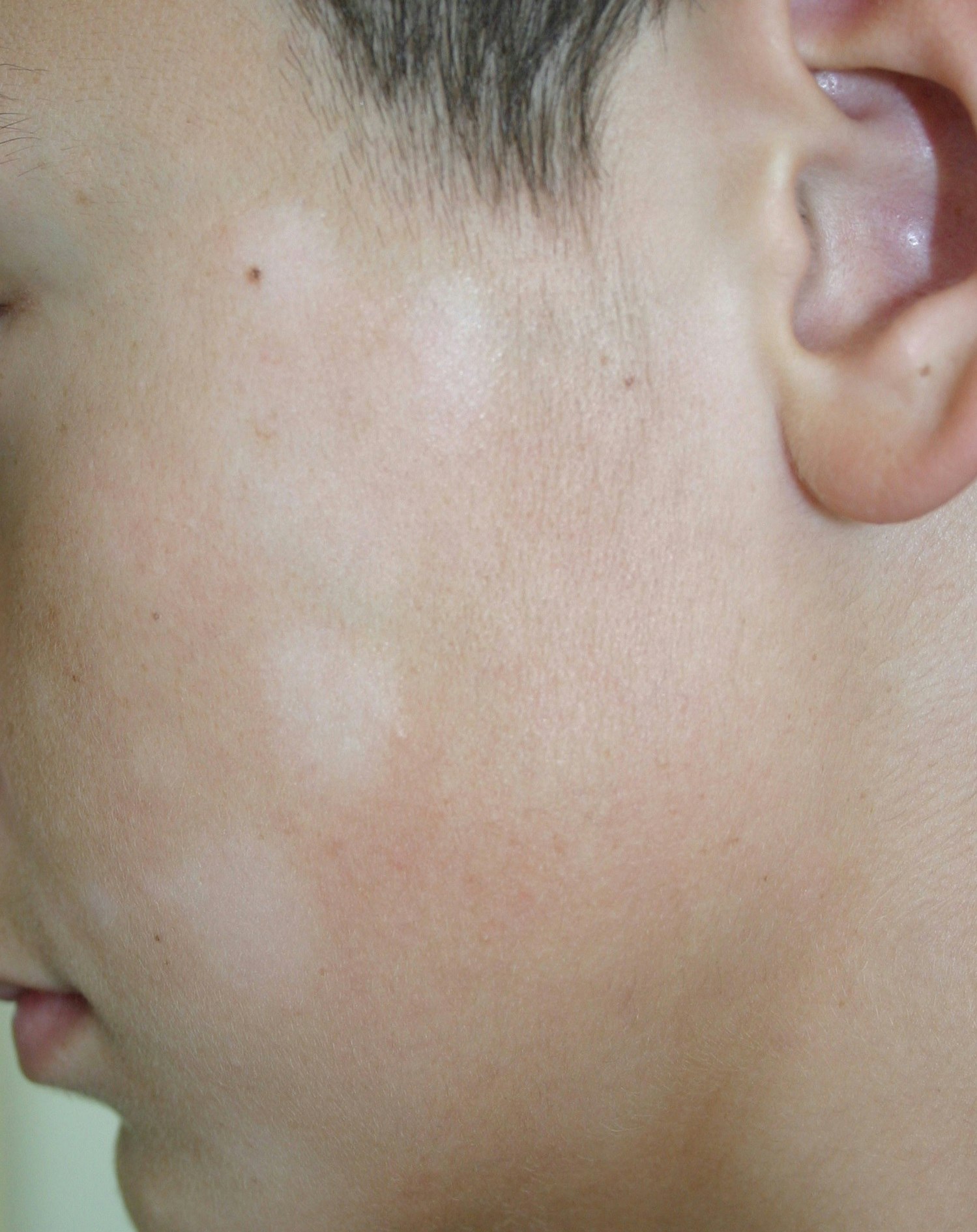 Pityriasis Alba: Symptomen, Oorzaken en Zelfzorg