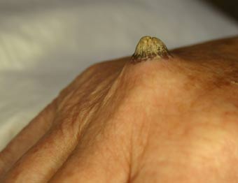 Cornu Cutaneum: Symptomen, Oorzaken, Diagnose en Behandeling