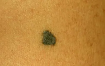 Nevus Azul - Información, Síntomas y Tratamiento