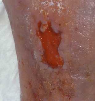 Ulcus Cruris: Oorzaken, Symptomen en Behandeling van Open Been