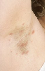 Informatie over Erythrasma: Symptomen en behandeling