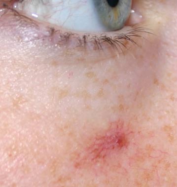 Spider Naevus: Oorzaken, Symptomen en Behandeling