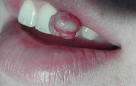 Alles over Granuloma Pyogenicum- Dermatology2Go