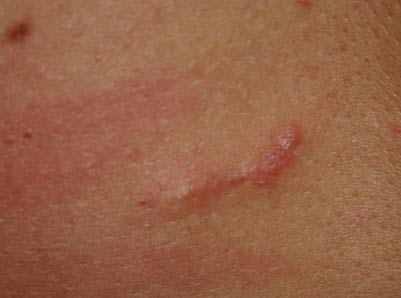 Larva Migrans: Symptoms, Causes, Diagnosis, and Treatment