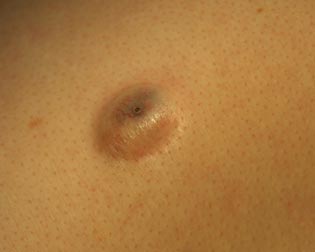 Epidermoid Cyst (Atheroma Cyst): Symptoms and Causes